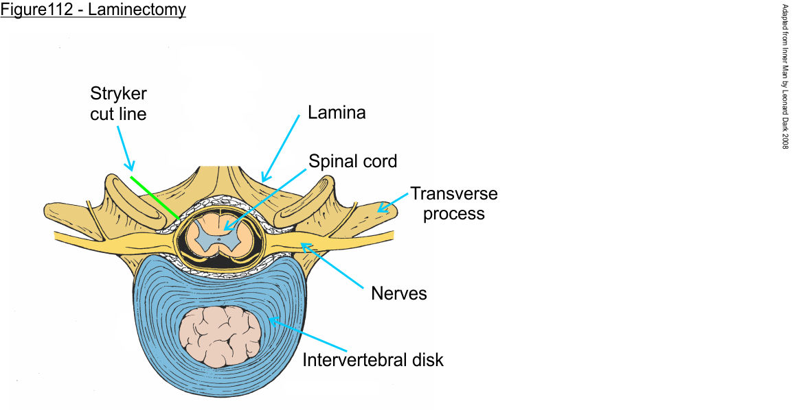 Figure112_LaminectomyLaminae