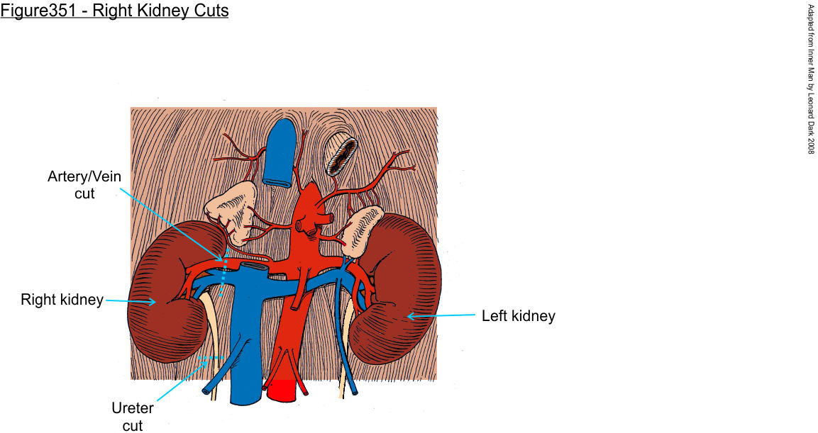Figure351_KidneyIncisions