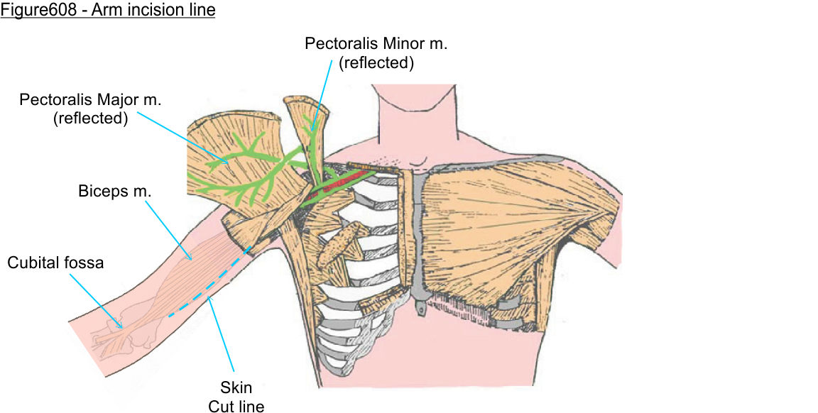 Figure608_ArmIncision