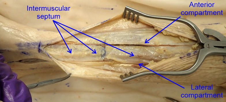 Clinical Leg Fasciotomy